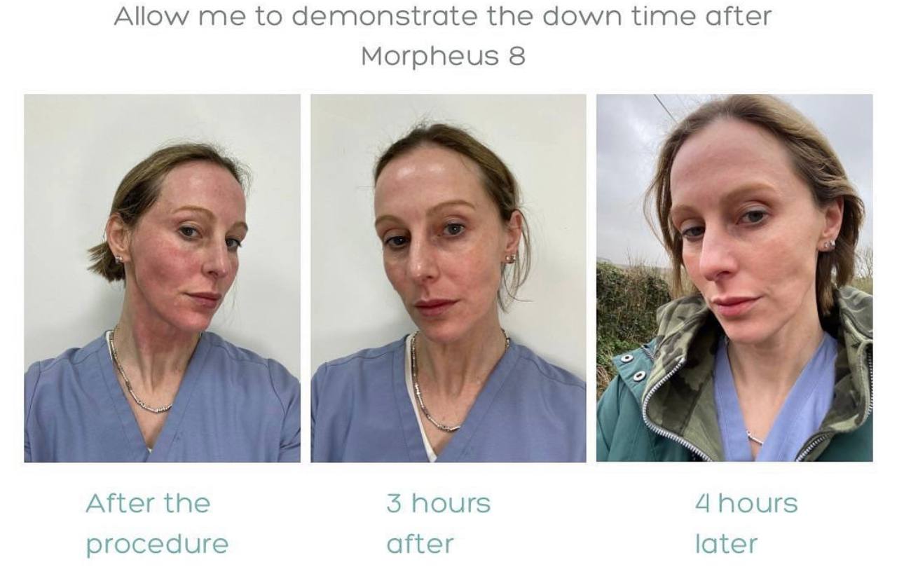 What is Morpheus 8? | Before/After | Dr Alison Elsey
