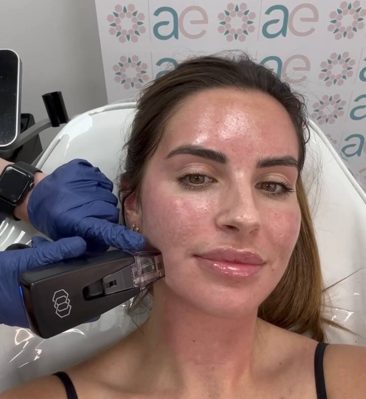 Forma & Morpheus 8 | Dr Alison Elsey